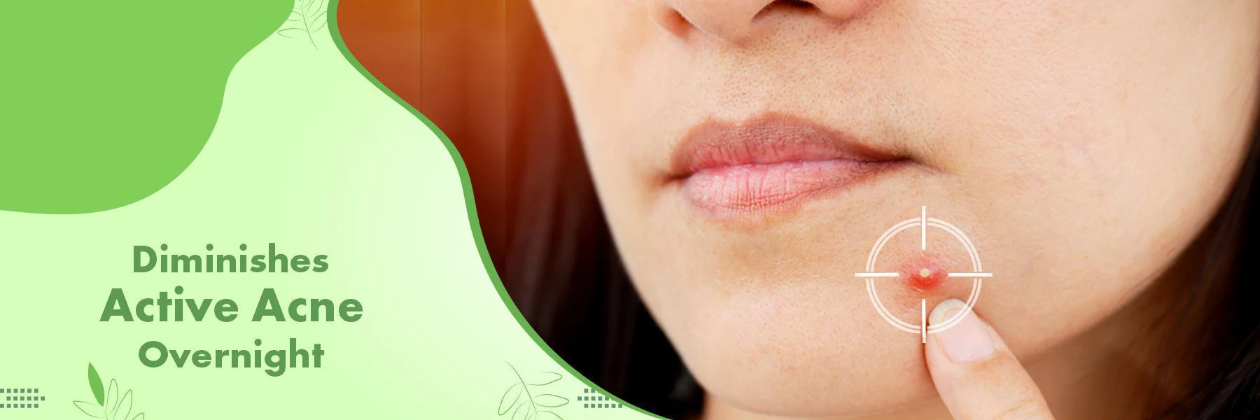 Pimple Patch: An effective way to reduce acne – UrbanYog